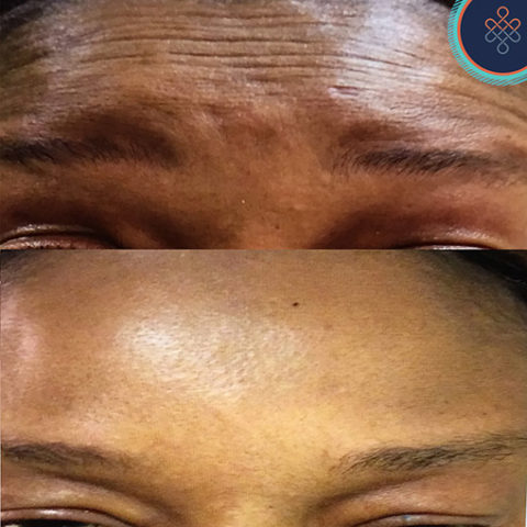 Conditions – Forehead Lines | Perpetual Aesthetics